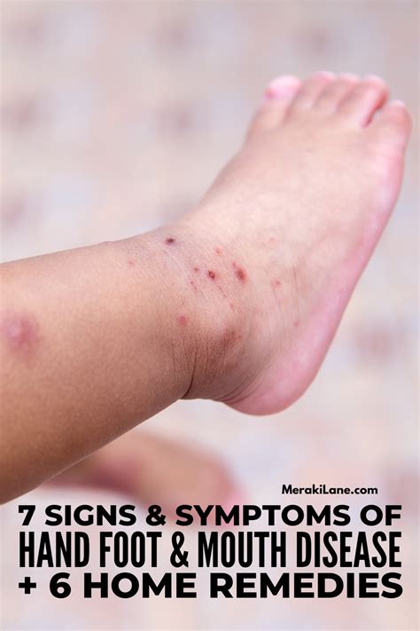 6 Natural Remedies For Hand Foot And Mouth Disease