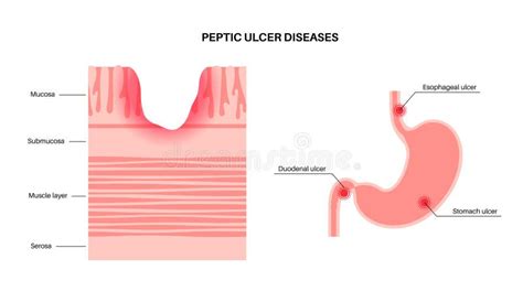 Peptic Ulcer Disease Stock Illustrations 587 Peptic Ulcer Disease