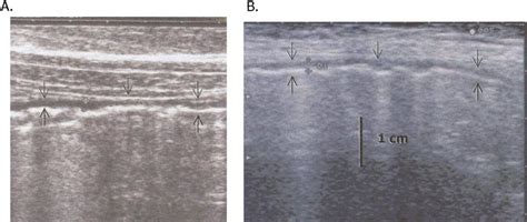 Hypoechoic And Thin Download Scientific Diagram