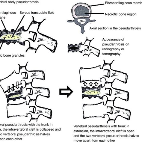 Constitution And Dynamics Of Vertebral Body Pseudoarthrosis Mobility Download Scientific