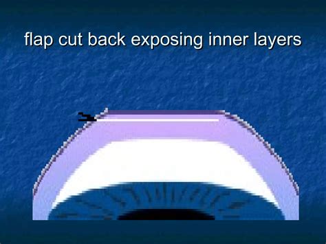 Astigmatism Common Eye Condition Ppt