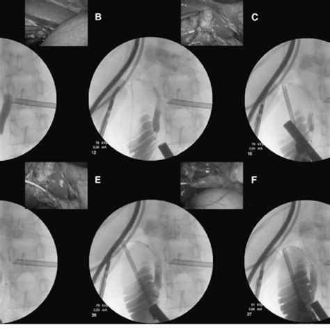 Pdf Laparoscopic Treatment For Unsuspected Common Bile Duct Stones By