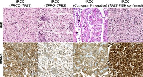 Representative Gpnmb Staining In Translocation Rcc Trcc Cases