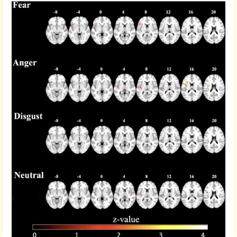 demonstration of the results of voxel based lesion symptom mapping