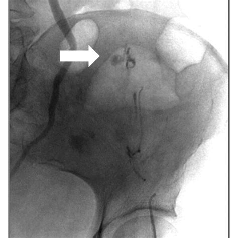 Arteriography And Angioembolization Of Previous Exampled Patients A