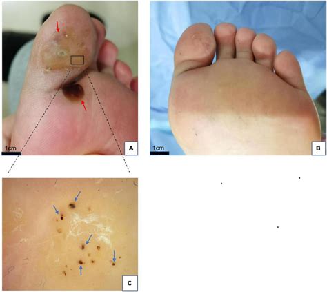 Plantar Wart Bleeding At Michael Birdwood Blog