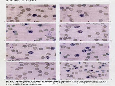 Reticulocyte Wright Stain