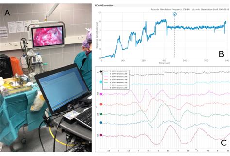 A State Of The Art Method For Preserving Residual Hearing During Cochlear Implant Surgery