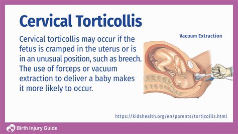 Spasmodic Torticollis