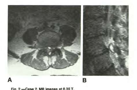 Figure 2 From Synovial Cysts Of The Lumbosacral Spine Diagnosis By Mr