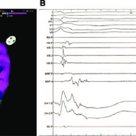Rv Voltage Mapping A Bipolar Voltage Map Of The Rv Viewed From A