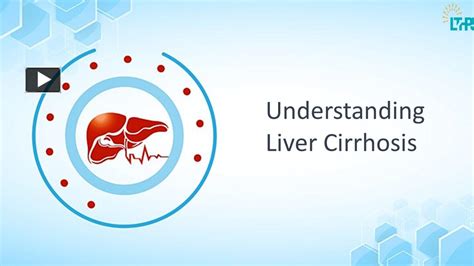 Understanding Liver Cirrhosis Causes Symptoms And Treatment Options