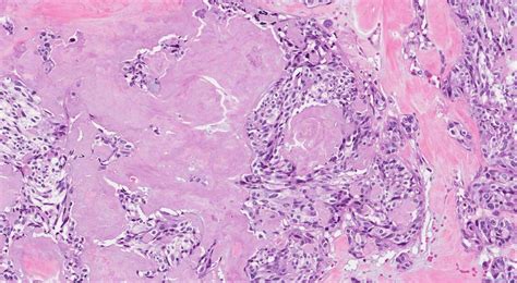 Medullary Thyroid Carcinoma Atlas Of Pathology