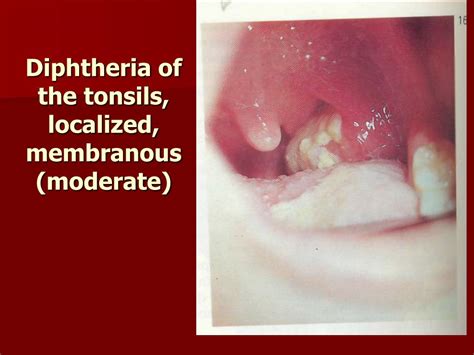 Ppt Infectious Diseases With Tonsillitis Diphtheria Powerpoint Presentation Id 6535961