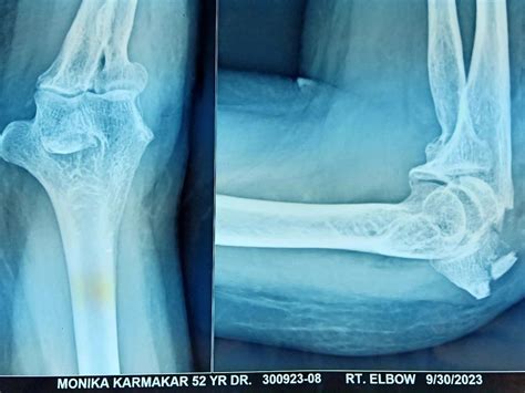 Dr Pathikrit Guha Niyogi On Linkedin Comminuted Olecranon Fracture In A 52 Yrs Old Housewife