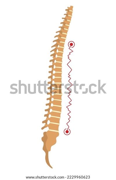 Spinal Deformity Symbol Spine Curvatures Unhealthy Stock Vector