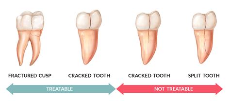 Cracked Tooth Dental Treatments Abroad Dental Clinic Heraklion Crete