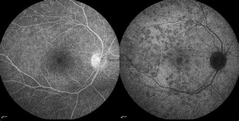 Multiple Evanescent White Dot Syndrome Mewds Retinara