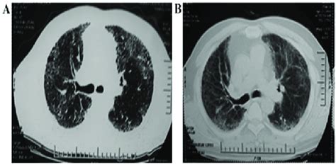 A Radiological Scan Showing The Effects Of Huc Msc Treatment Before And