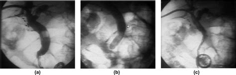Stone Removal A Cholangiogram Shows Retained Large Stone In The Cbd