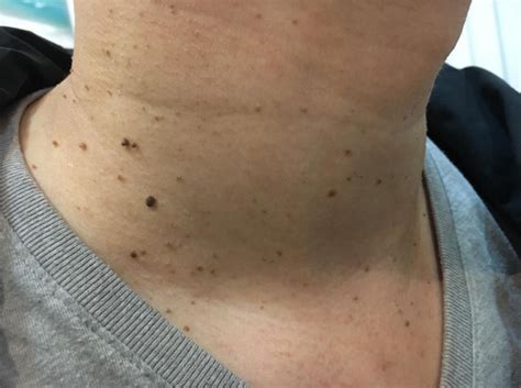 皮膚息肉皮膚瘜肉 確研皮膚專科中心 皮膚科醫生｜脫疣治療、濕疹治療、銀屑病