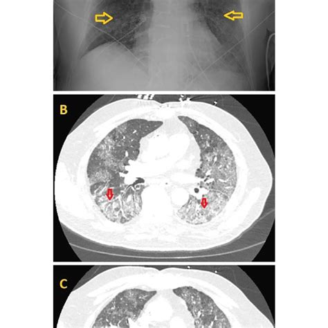 Repeat Chest X Ray Cxr And High Resolution Chest Ct Scan Findings 6a Download Scientific
