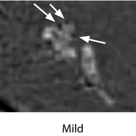 Sample Images Using Hybrid Of Reversed Image Of Positive Endolymph