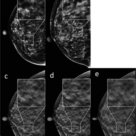 Pdf Diagnostic Performance Of Digital Breast Tomosynthesis For Breast Suspicious