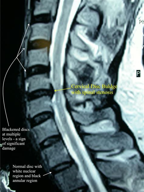 Slip Disc Cervical Spondylosis Dorothy Cameron