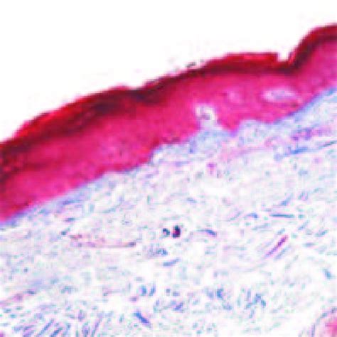 Elastosis With Degeneration Of Dermal Tissue Deposition Of Elastic Fibres Download Scientific