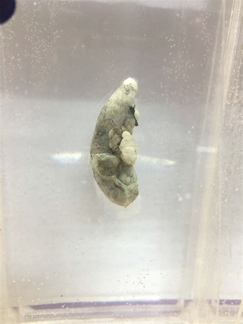 Acute Appendicitis Gross Histopathologyguru