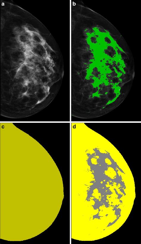 Semi Automated Detection Of Mammographic Breast Density A Standard Download Scientific Diagram