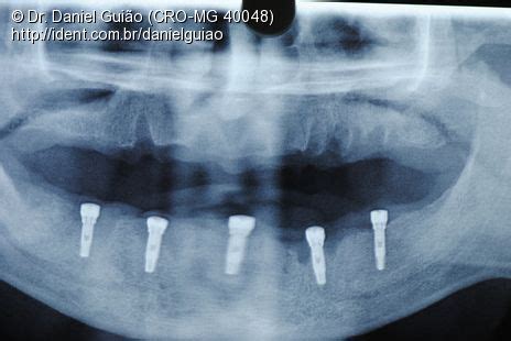 Protocolo Inferior Sobre Implantes Caso clínico iDent