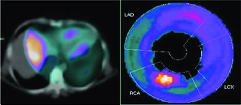 Cardiac Imaging In A Patient With Takotsubo Cardiomyopathy A Download Scientific Diagram