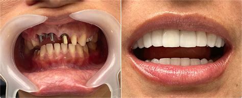 Implantes Dentales Antes Y Después