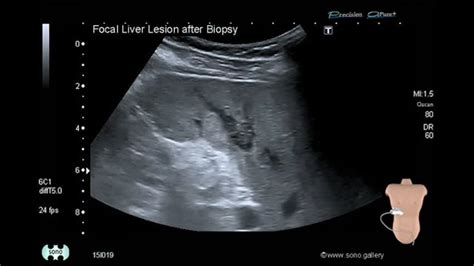 Autoimmune Cholangitis Sonogallery