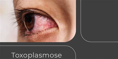 Toxoplasmose Ocular Iomr Instituto De Oftalmologia Marco Rey