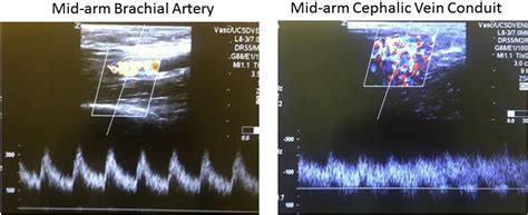 Estimation Of Brachial Artery Volume Flow By Duplex Ultrasound Imaging