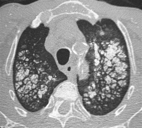 Axial Ct Scan Demonstrating Multiple Bilateral Centrilobular Calcified