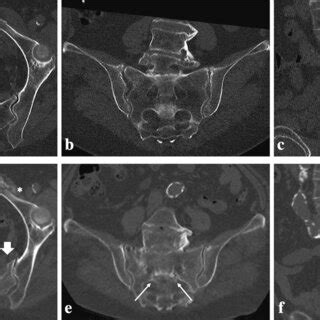Reconstructions Of Initial And Follow Up Preoperative CT Imaging In The Download Scientific