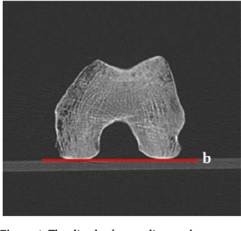 Figure 5 From Using The Axial Oblique View Of Computed Tomography Ct