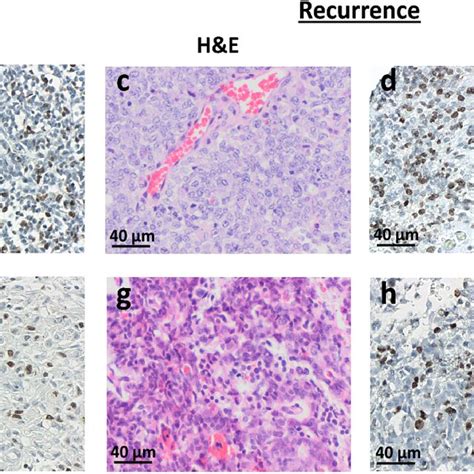 Histological Features Of Recurrent Atrt Compared To Primary Tumors