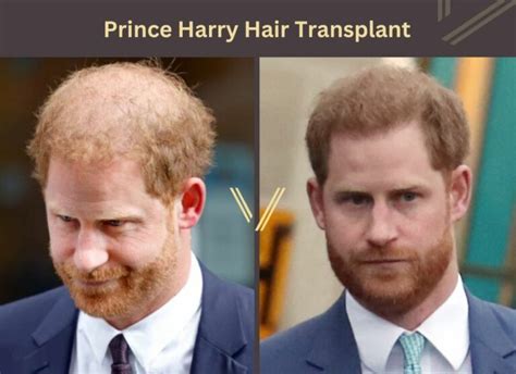 Celebrities With Hair Transplants Before After Photos