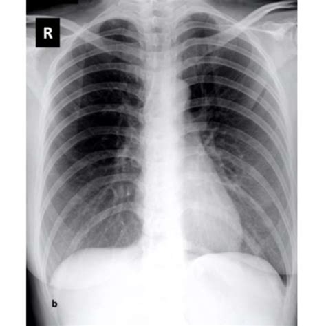 Covid 19 Image Dataset Kaggle