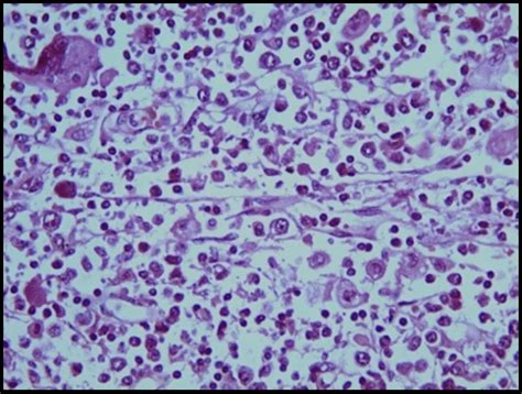 Lymph Node At 400x Expanded Sinuses Shows Megakaryocytes Normoblasts Download Scientific