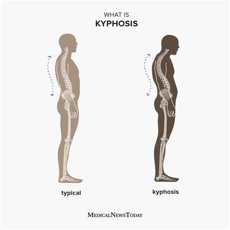 Kyphosis Opposite At Oliver Lindgren Blog