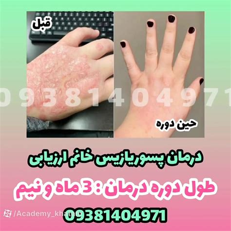 علت بیماری پسوریازیس