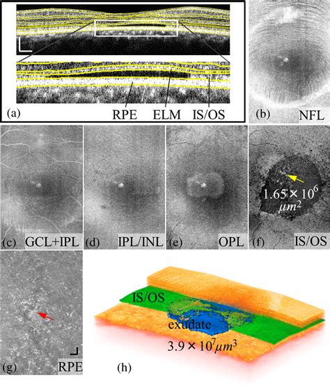 User Guided Segmentation For Volumetric Retinal Optical Coherence
