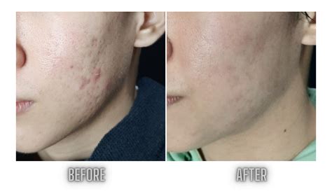 Discovery Pico Laser Selangor Subang Jaya Malaysia Services Health