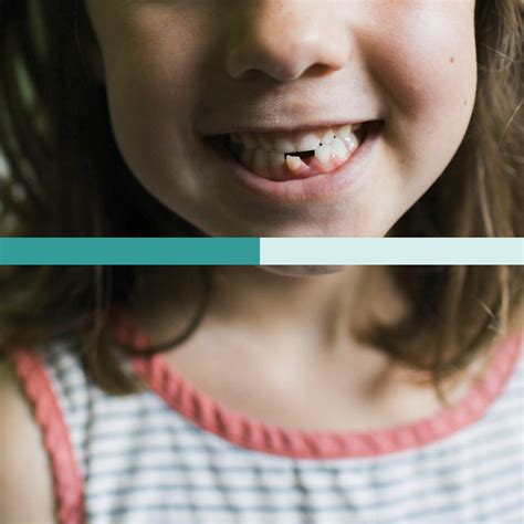 Cómo Reaccionar Ante Un Traumatismo Dental Infantil Clínica Dental